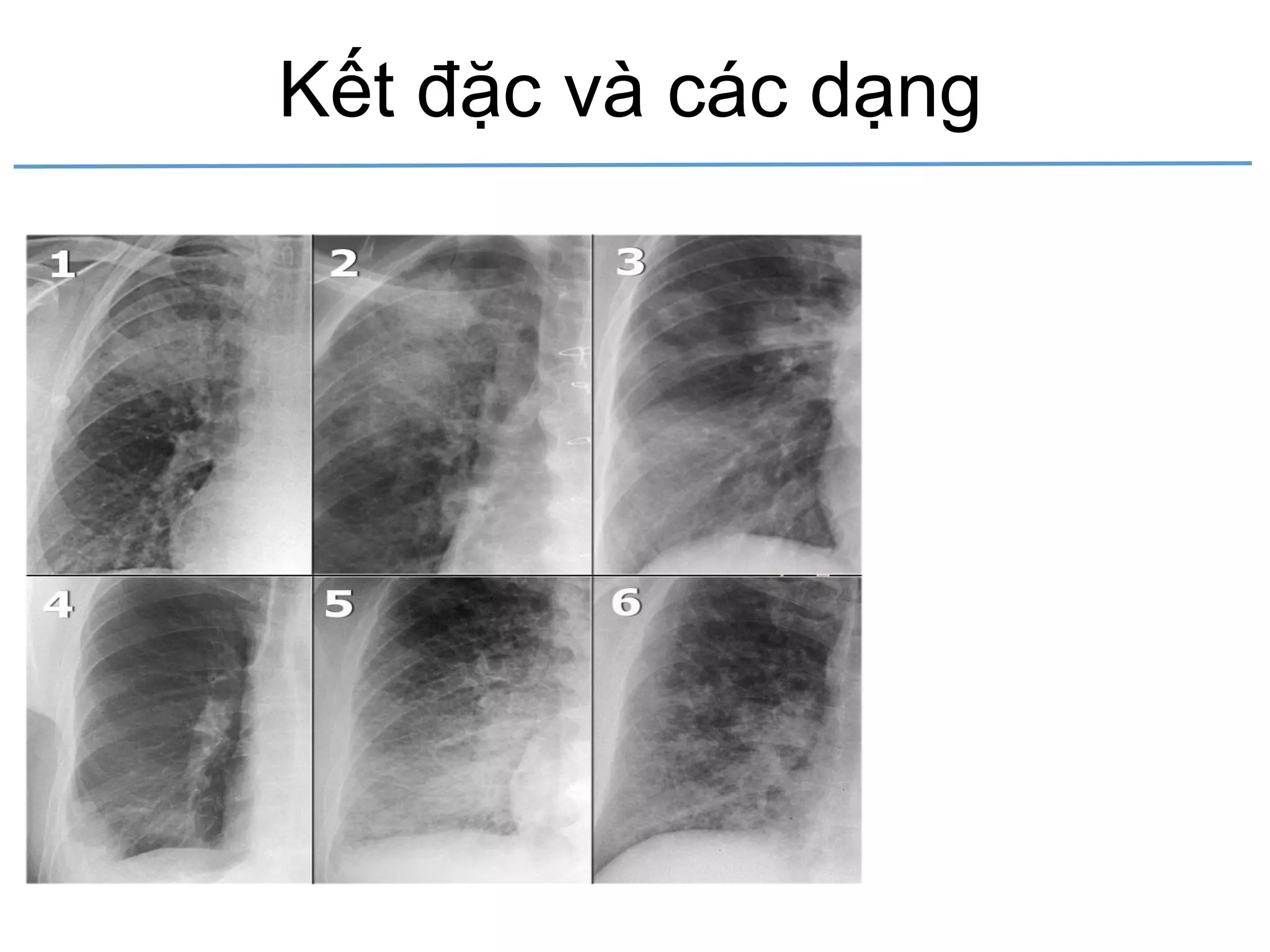 Xquang ngực cơ bản | PDF