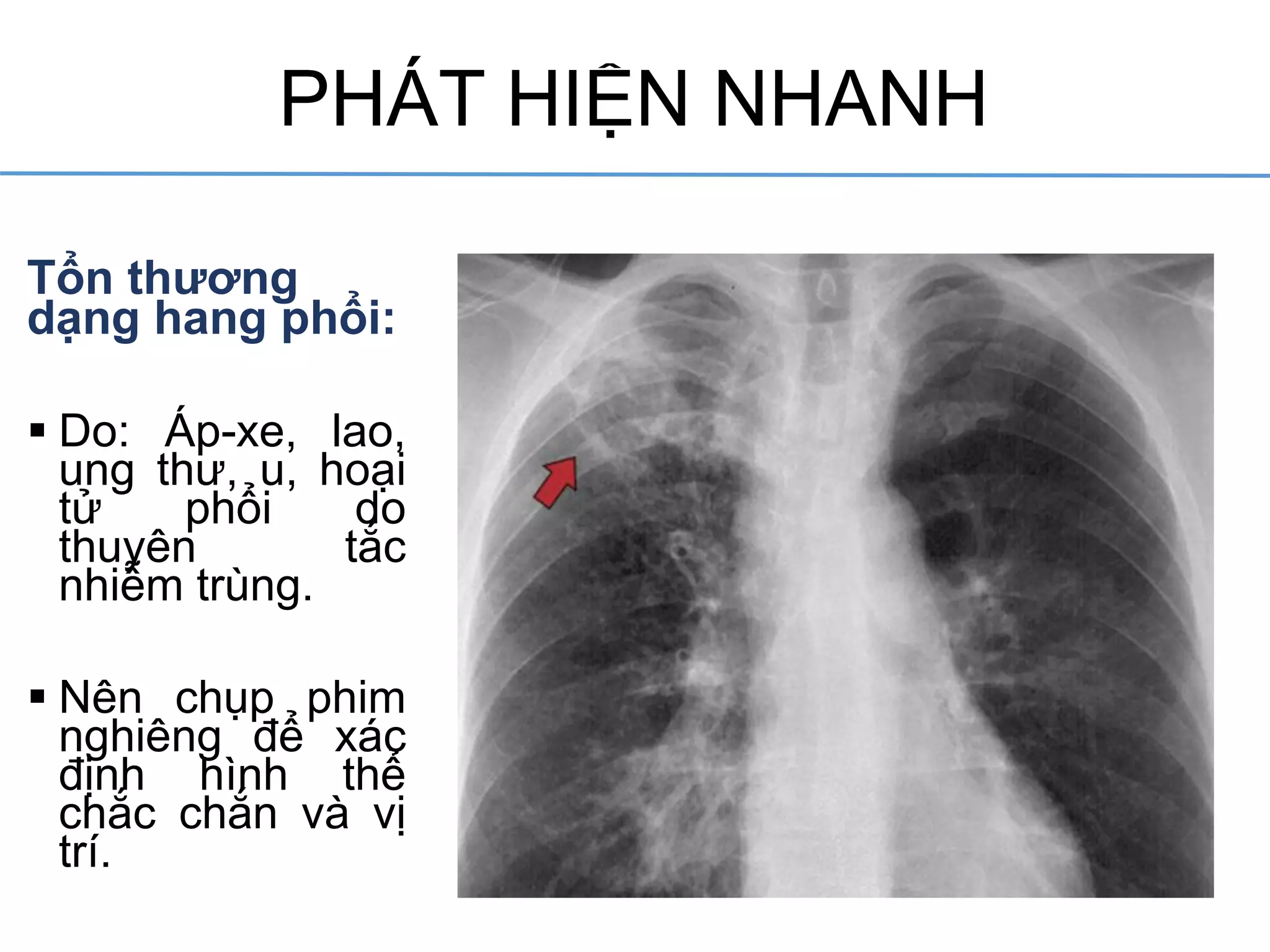 Xquang ngực cơ bản | PDF