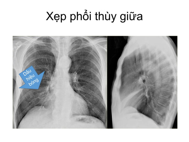 Xquang ngực cơ bản | PDF