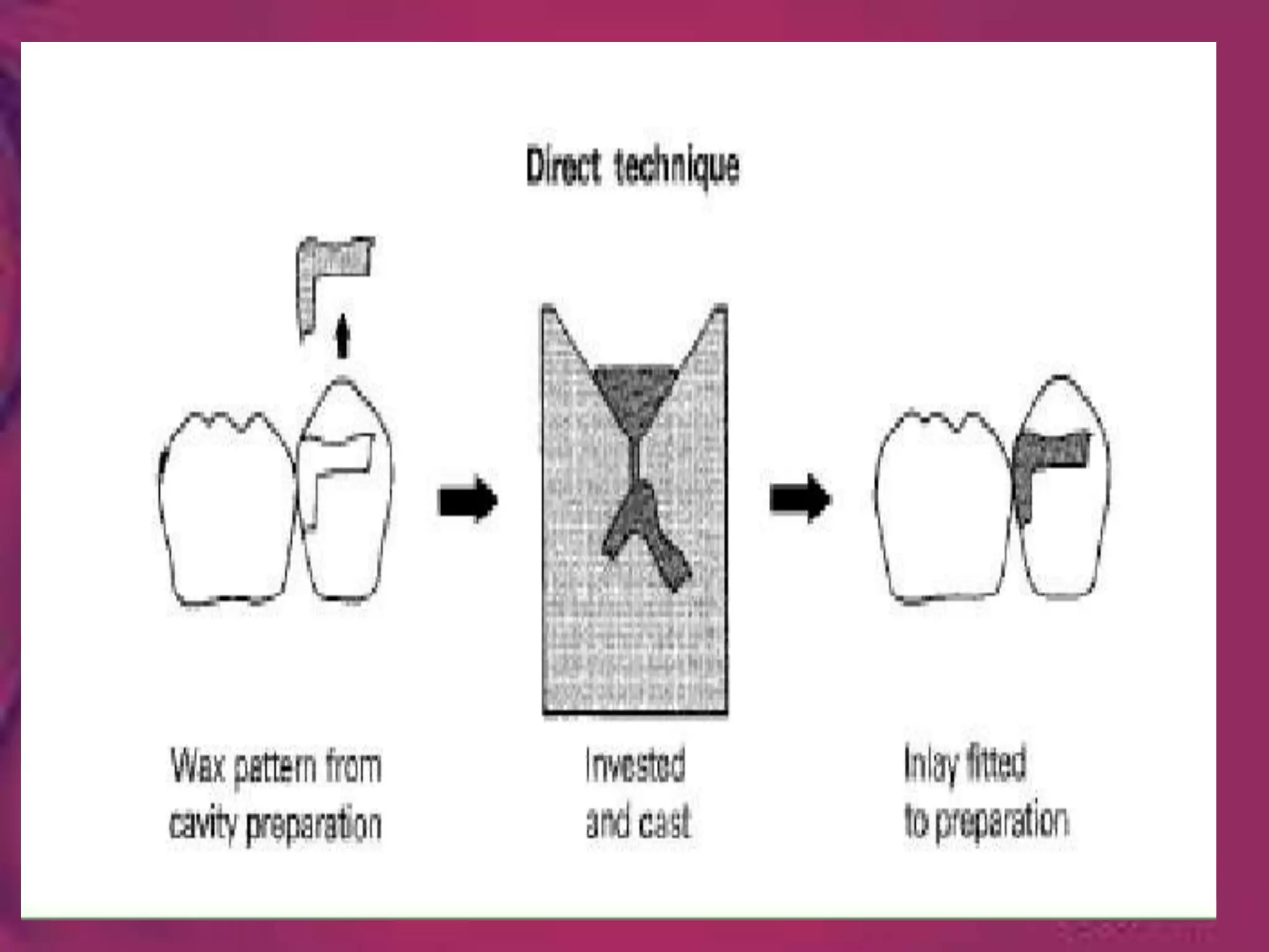 7.CLASS II INLAY CAVITY PREPARATION.pptx