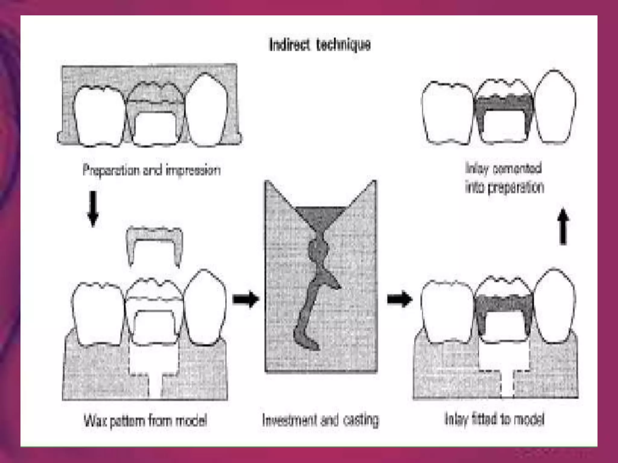 7.CLASS II INLAY CAVITY PREPARATION.pptx