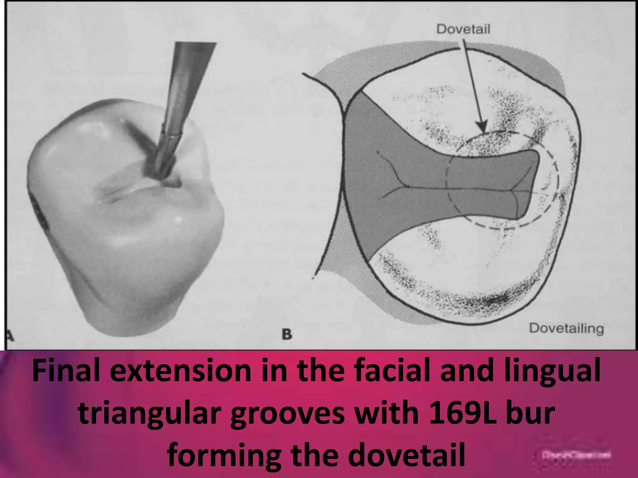 7.CLASS II INLAY CAVITY PREPARATION.pptx