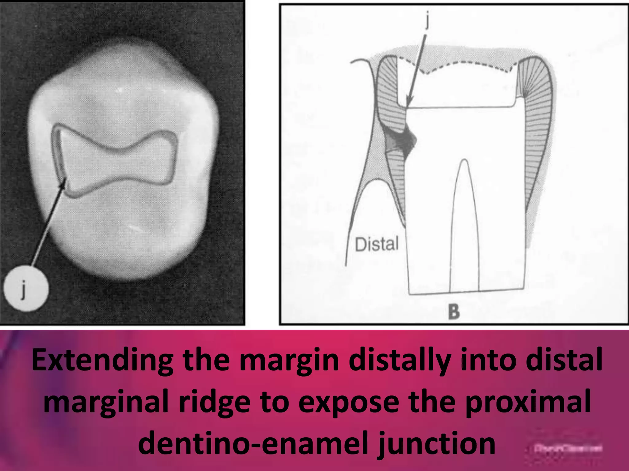 7.CLASS II INLAY CAVITY PREPARATION.pptx