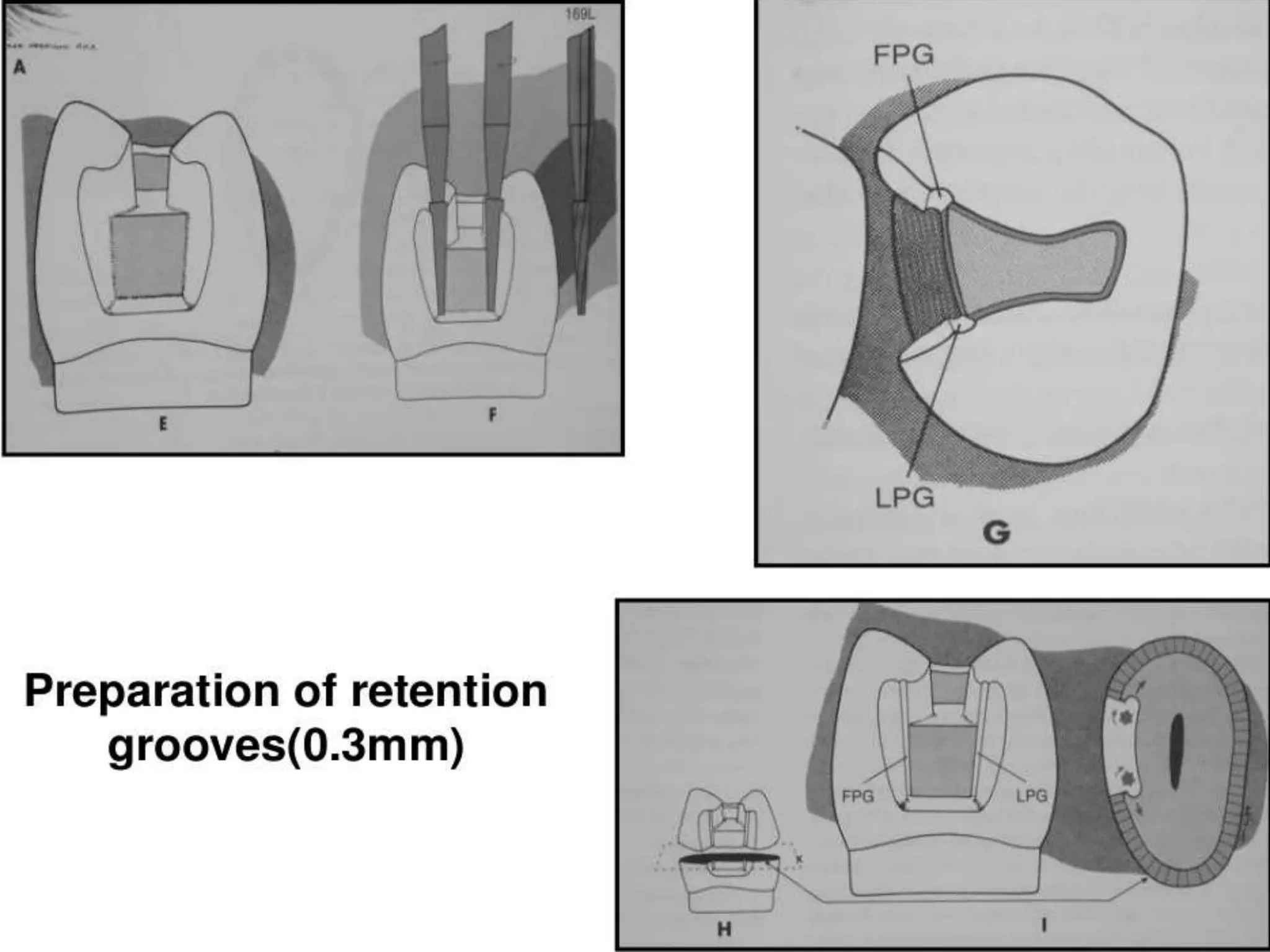7.CLASS II INLAY CAVITY PREPARATION.pptx