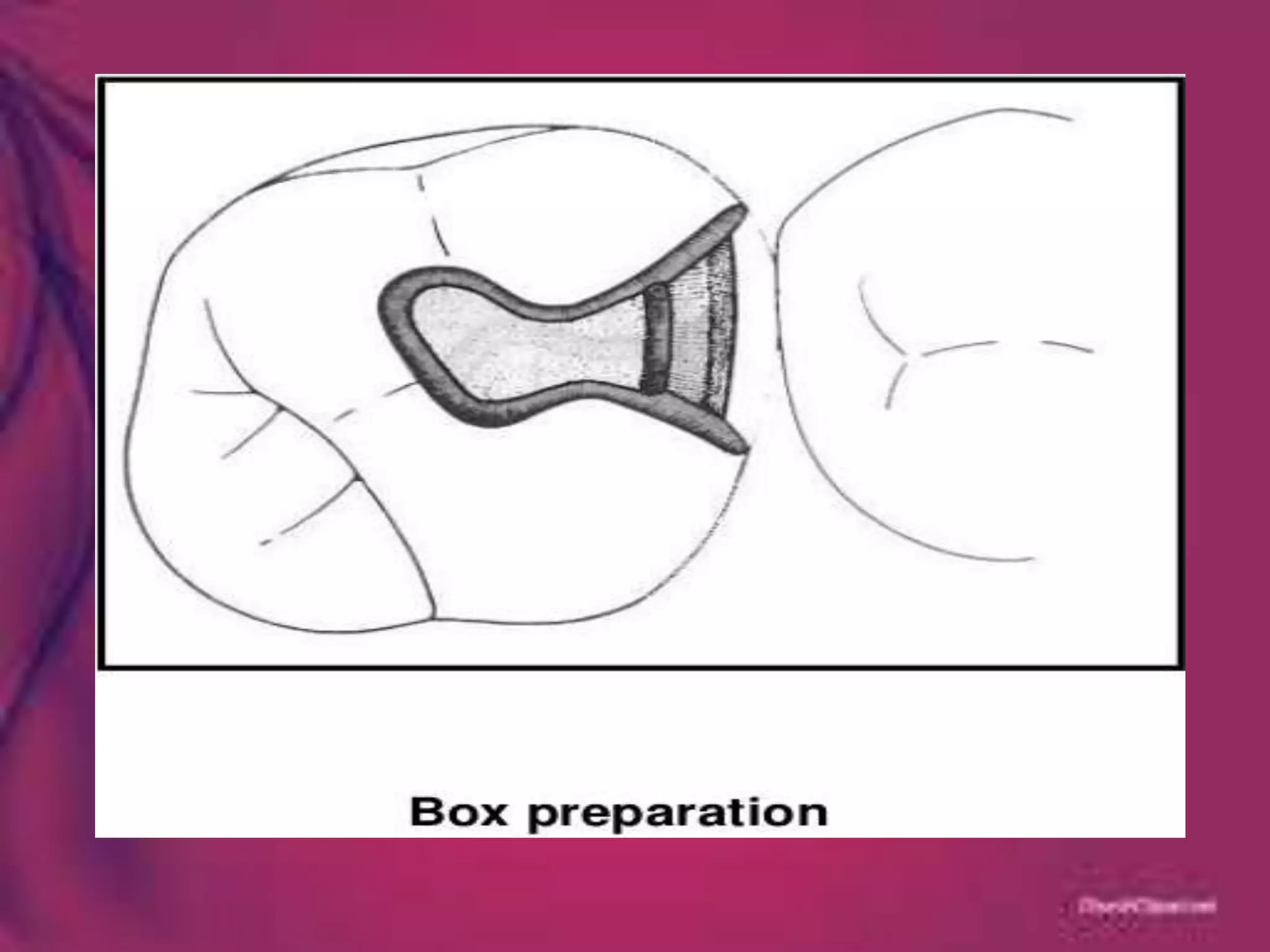 7.CLASS II INLAY CAVITY PREPARATION.pptx