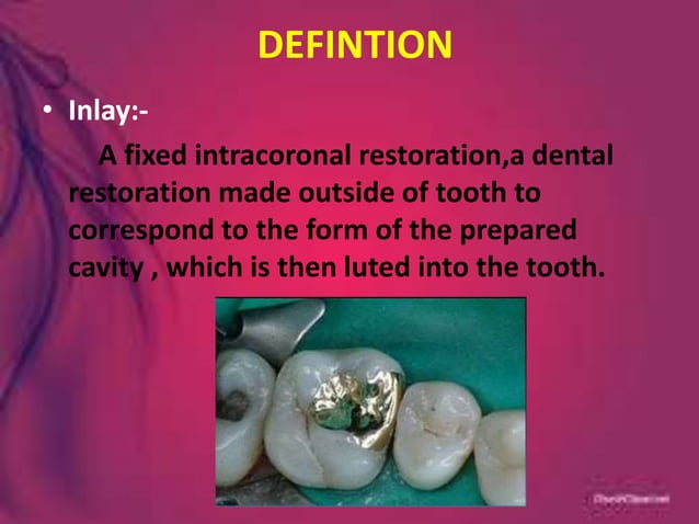 7.CLASS II INLAY CAVITY PREPARATION.pptx | Oral care | Personal Care