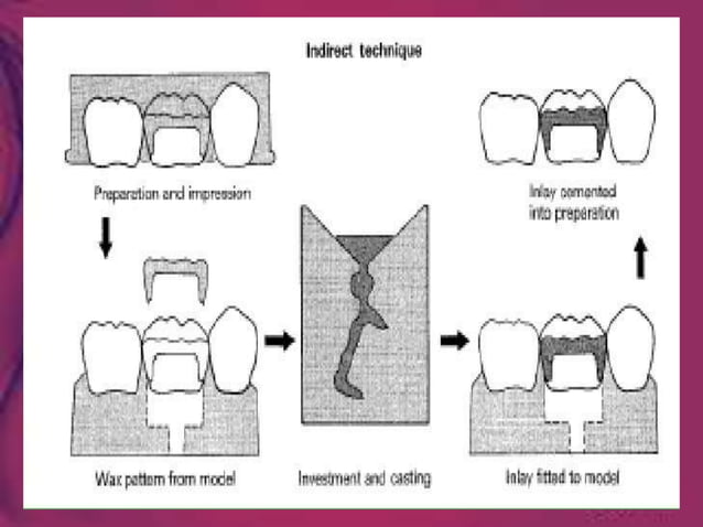 7.CLASS II INLAY CAVITY PREPARATION.pptx | Oral care | Personal Care
