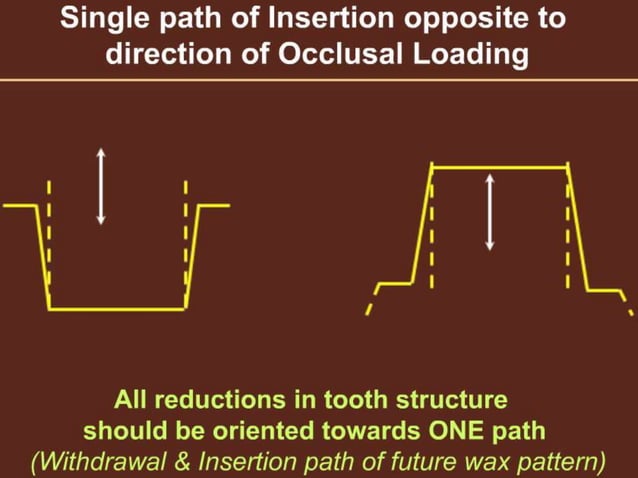 7.CLASS II INLAY CAVITY PREPARATION.pptx | Oral care | Personal Care