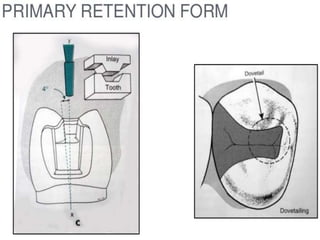 7.CLASS II INLAY CAVITY PREPARATION.pptx