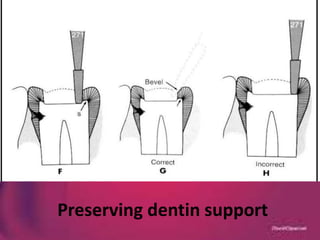 7.CLASS II INLAY CAVITY PREPARATION.pptx