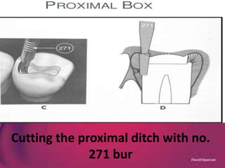 7.CLASS II INLAY CAVITY PREPARATION.pptx