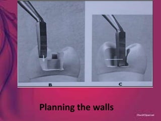 7.CLASS II INLAY CAVITY PREPARATION.pptx