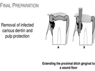 7.CLASS II INLAY CAVITY PREPARATION.pptx