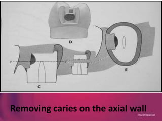 7.CLASS II INLAY CAVITY PREPARATION.pptx