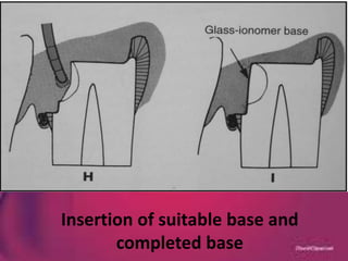7.CLASS II INLAY CAVITY PREPARATION.pptx