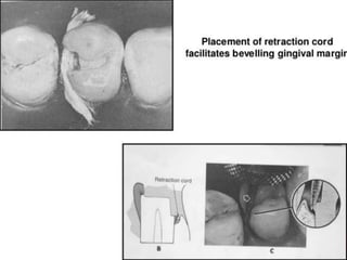 7.CLASS II INLAY CAVITY PREPARATION.pptx