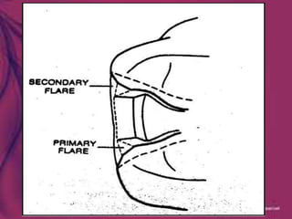 7.CLASS II INLAY CAVITY PREPARATION.pptx