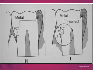 7.CLASS II INLAY CAVITY PREPARATION.pptx