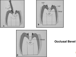 7.CLASS II INLAY CAVITY PREPARATION.pptx