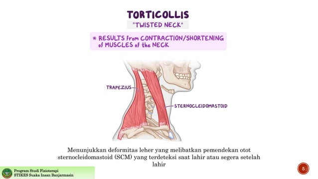 FISIOTERAPI PEDIATRI PADA KASUS - TORTICOLIS.pptx