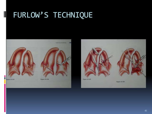 7.Cleft palate and lip.pptsscnsn snssnnsn | PPT