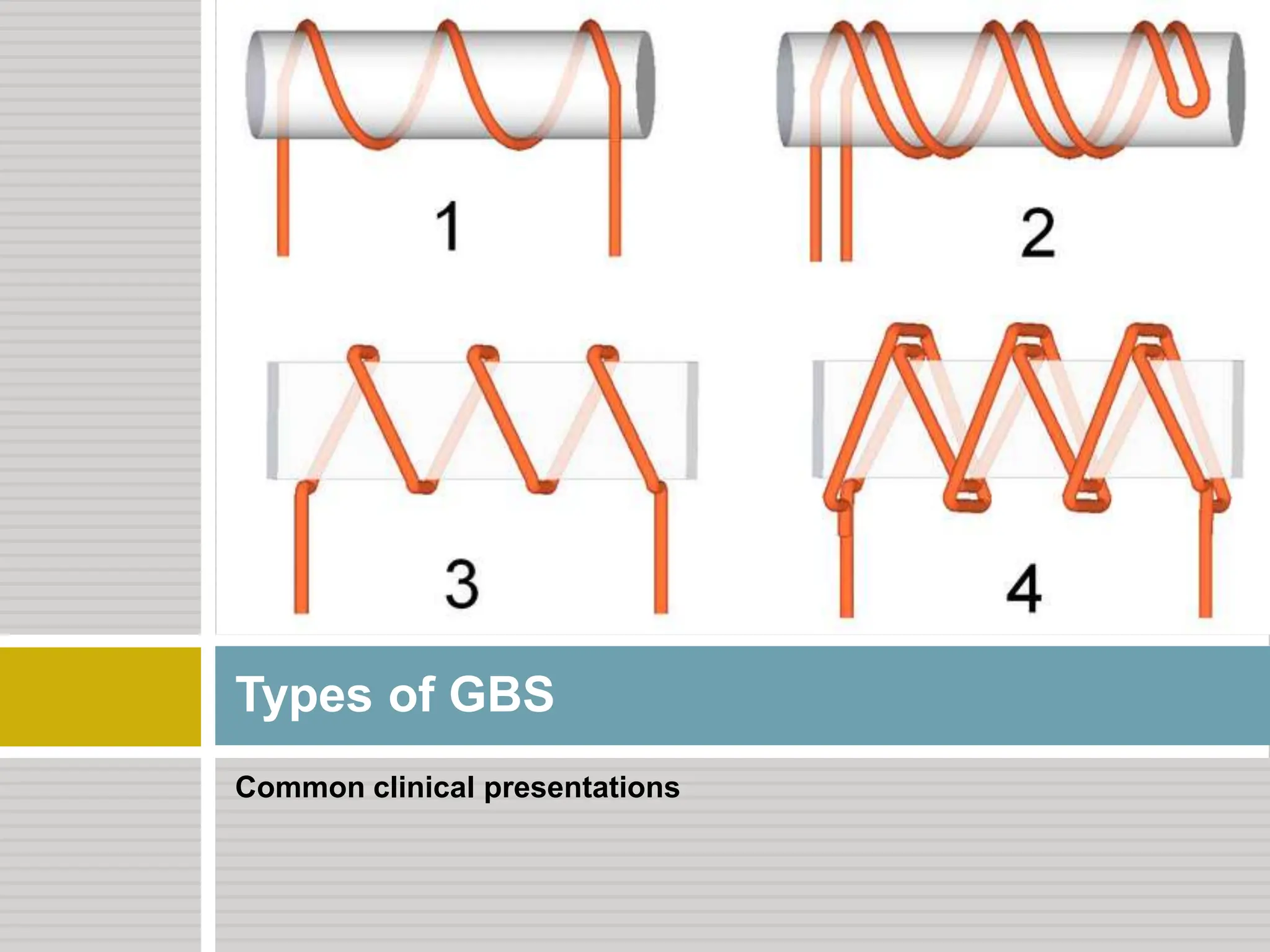 7. GBS , Gullian Barre Syndrome and Role of IVIg.pptx
