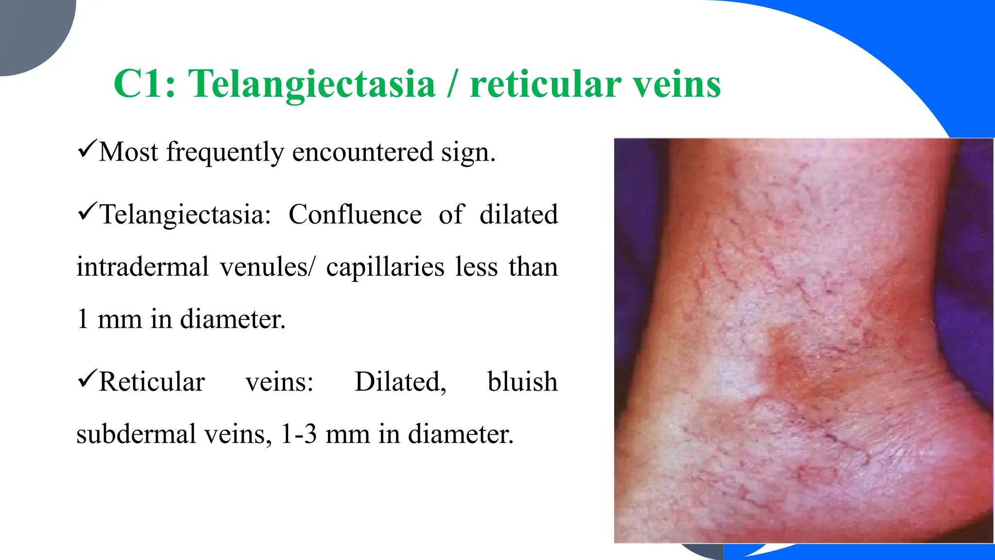 venous ulcer and venous insufficiency.ppt