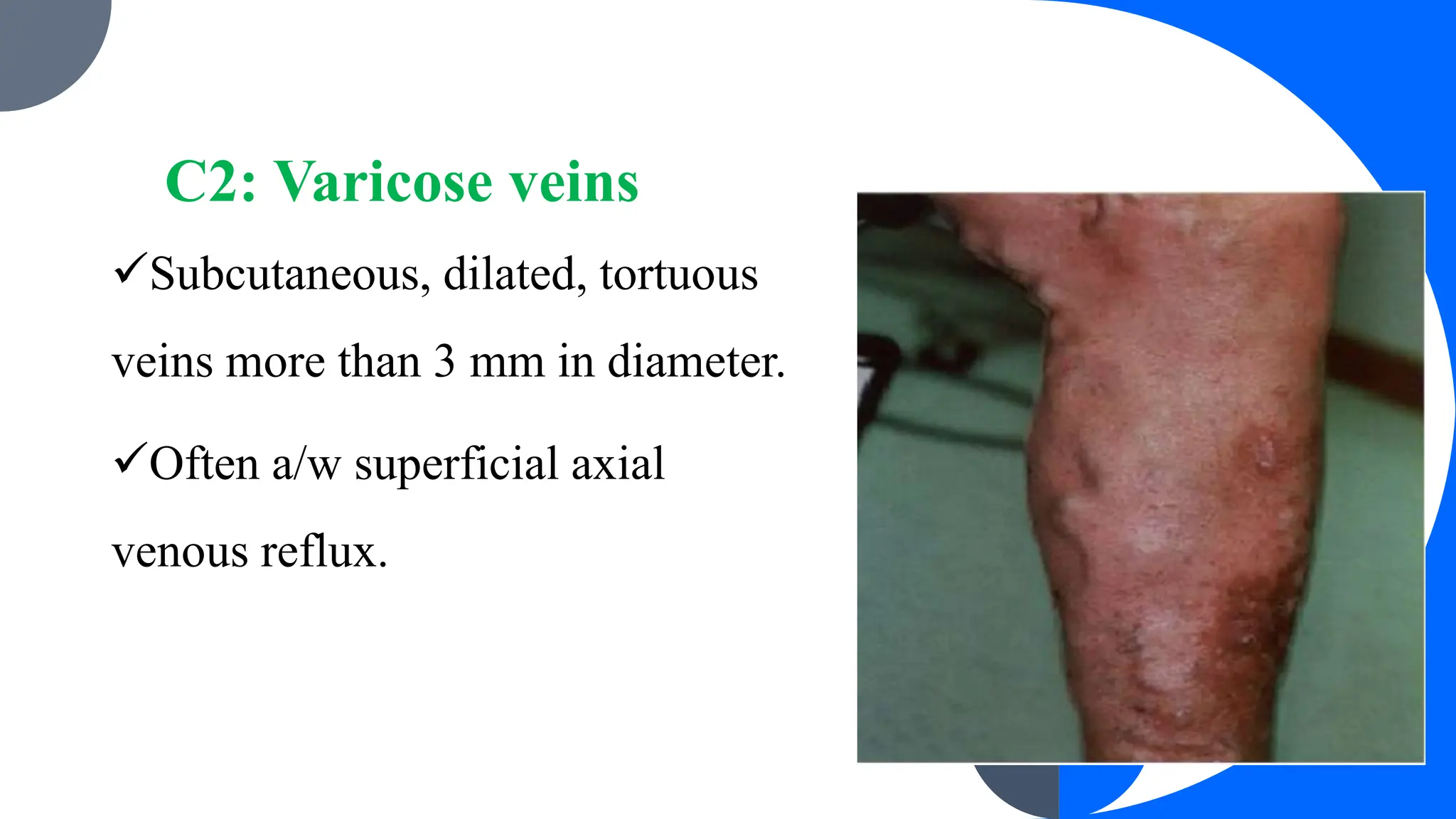 venous ulcer and venous insufficiency.ppt
