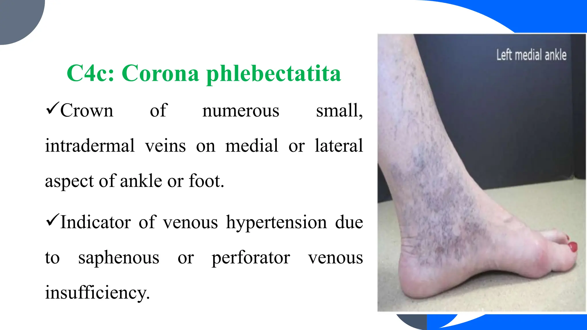 venous ulcer and venous insufficiency.ppt