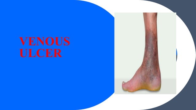 venous ulcer and venous insufficiency.ppt