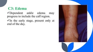 venous ulcer and venous insufficiency.ppt
