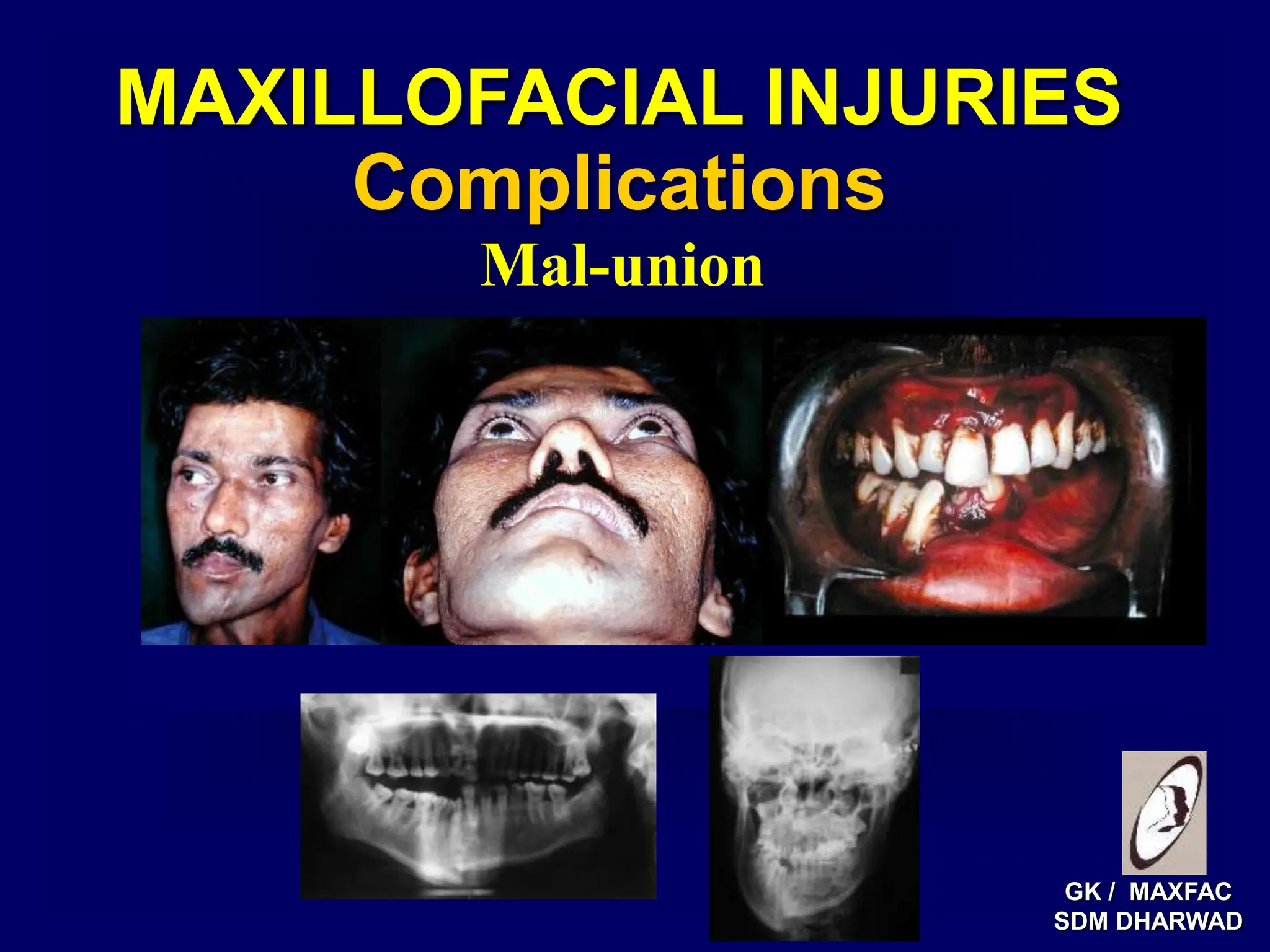 Complications of maxfax injuries pptx. 7 | PPT
