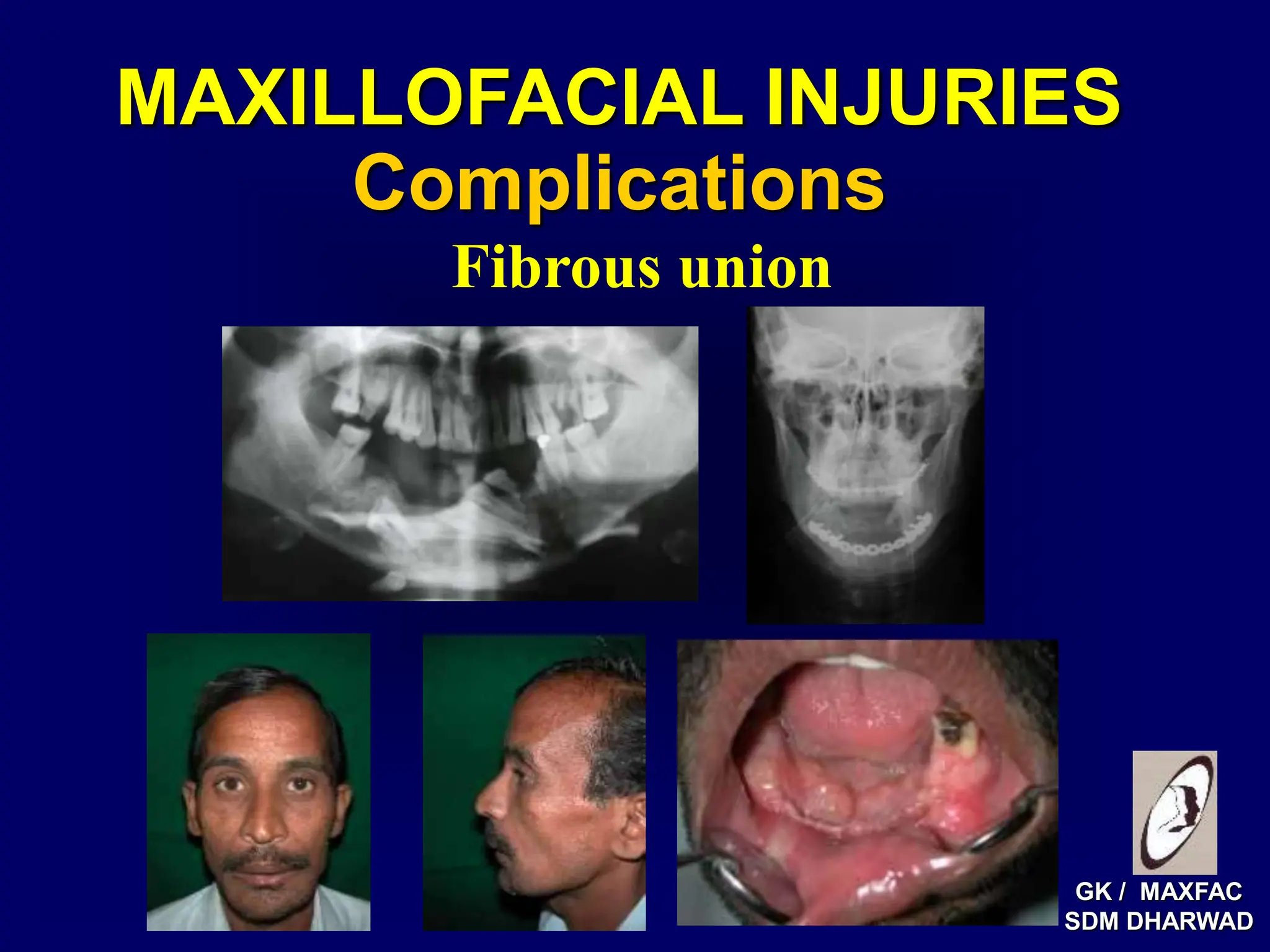 Complications of maxfax injuries pptx. 7 | PPT