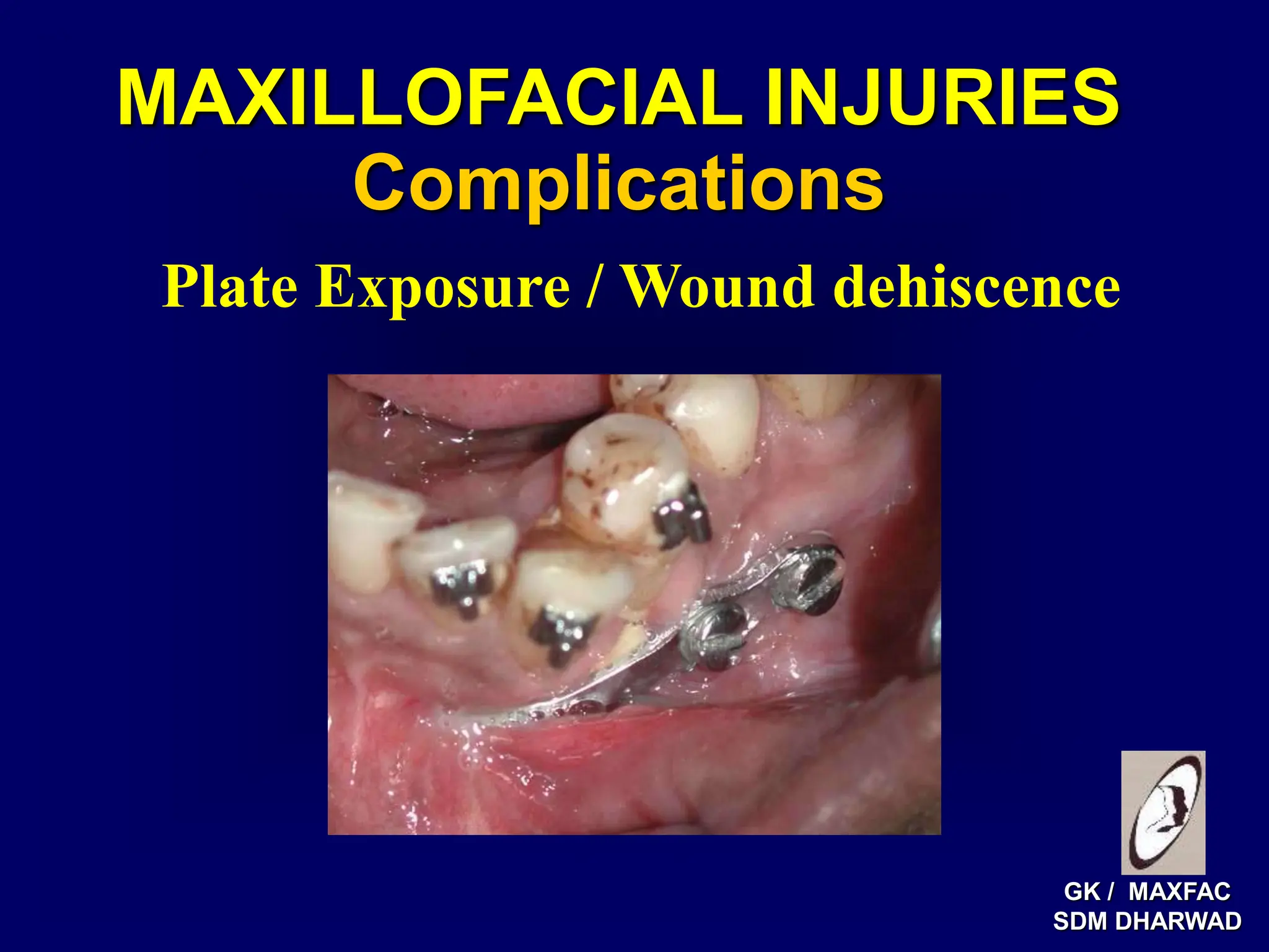 Complications of maxfax injuries pptx. 7 | PPT