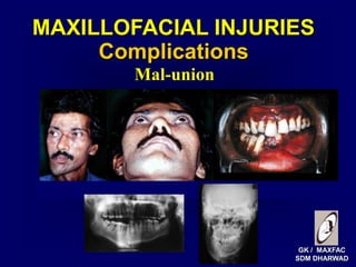 Complications of maxfax injuries pptx. 7 | PPT