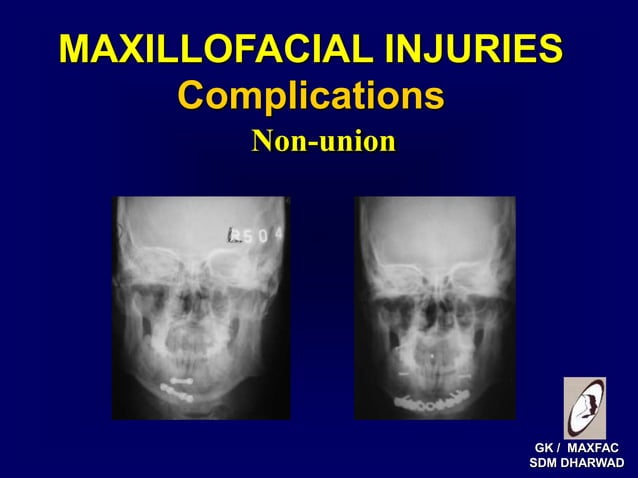 Complications of maxfax injuries pptx. 7 | PPT