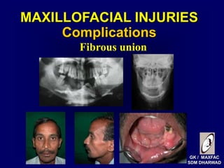 Complications of maxfax injuries pptx. 7 | PPT
