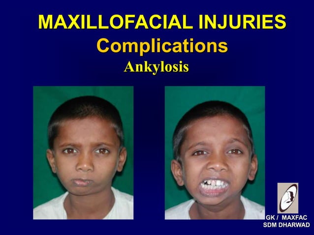 Complications of maxfax injuries pptx. 7 | PPT