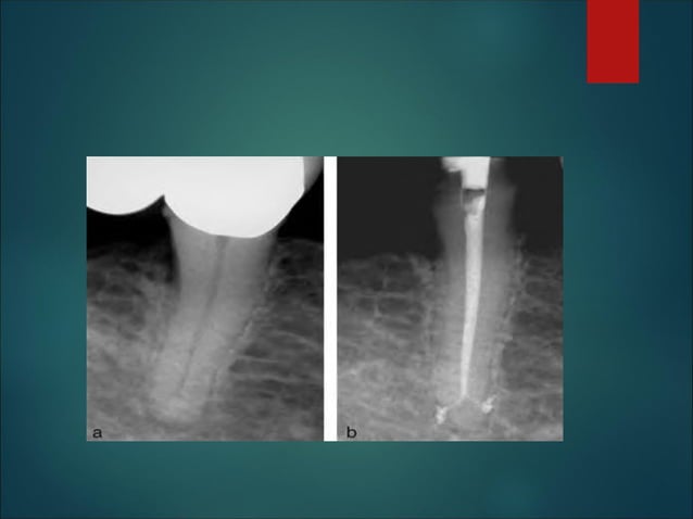 GERIATRIC -recent pulp exposure and restoretion | PPT | Dental Health ...