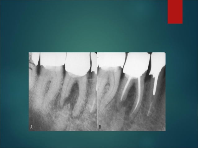 GERIATRIC -recent pulp exposure and restoretion | PPT | Dental Health ...