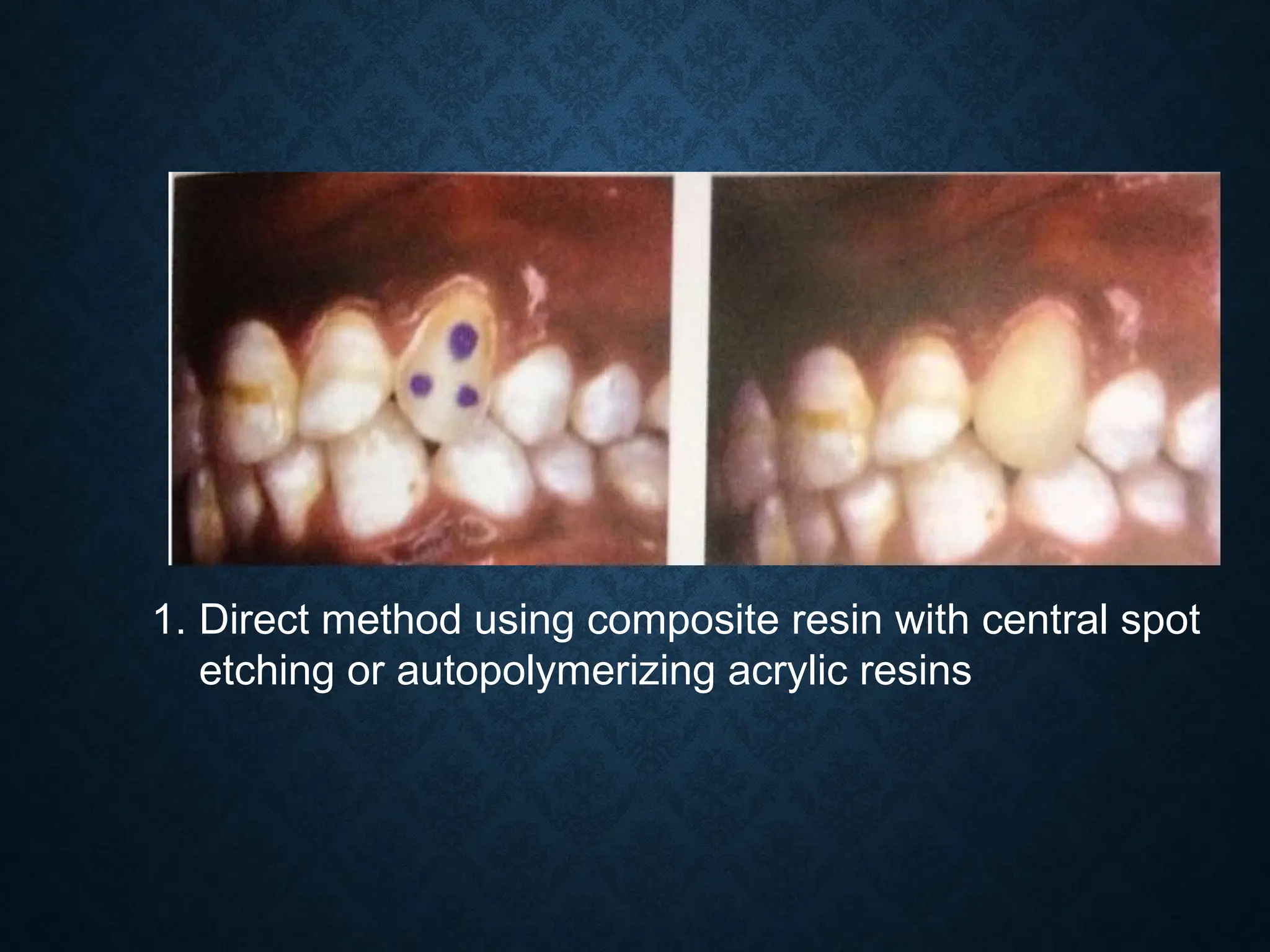THE ROLE OF PORCELAIN VENEERS IN PROSTHODONTICS | PPTX