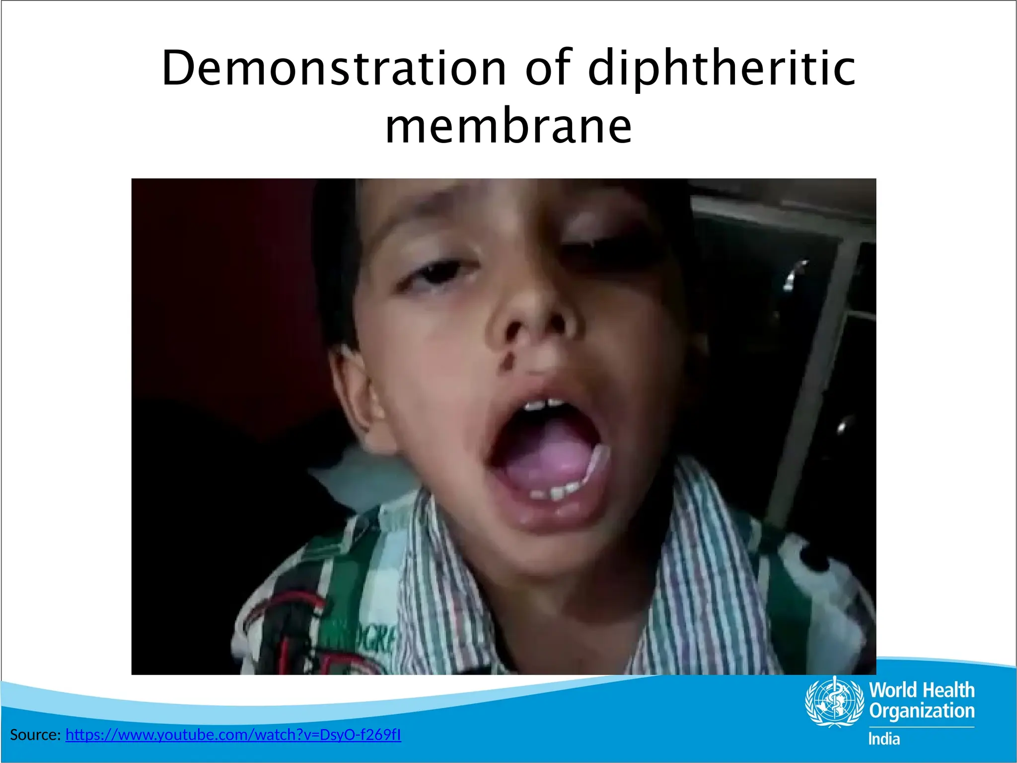 7. DPT Surveillance & Clinical presentation | PPTX