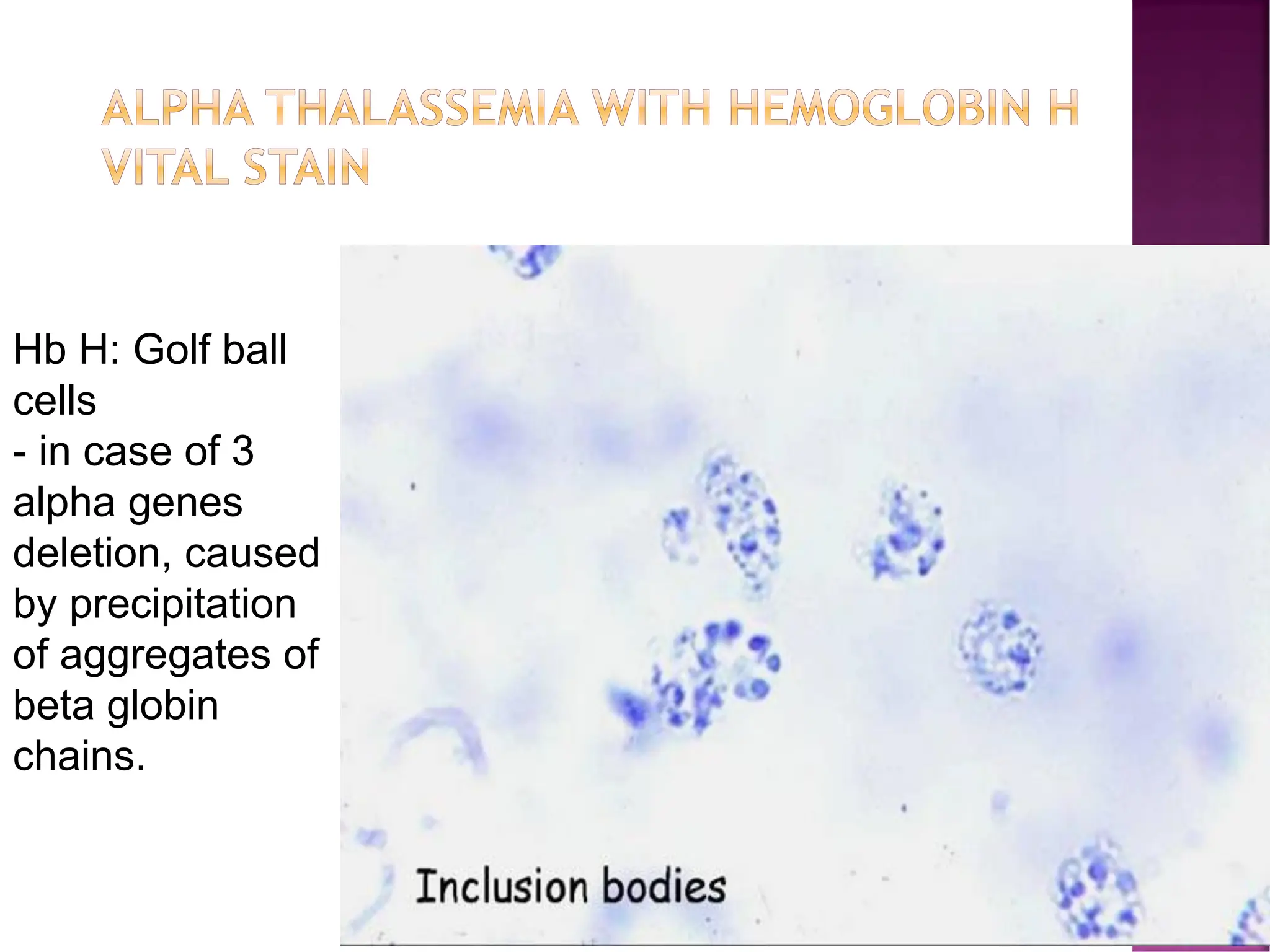 Hemoglobinopathies/Thalassaemias- Alphaa | PDF
