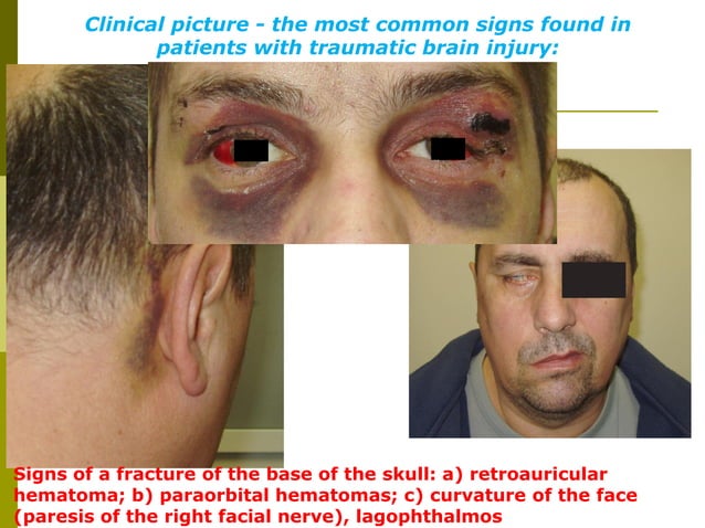 Injury. Open and closed injuries. Injuries of soft tissues, head, chest ...