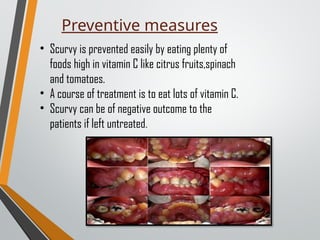 7. Nutritional Disorders.v semister nursing | PPTX