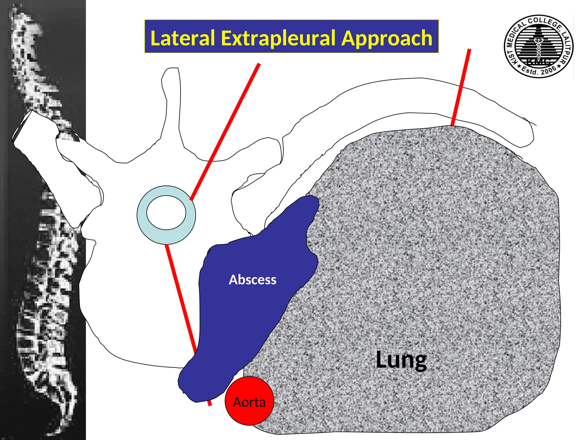 7. Presentation Spinal Tuberculosis-modified.ppt