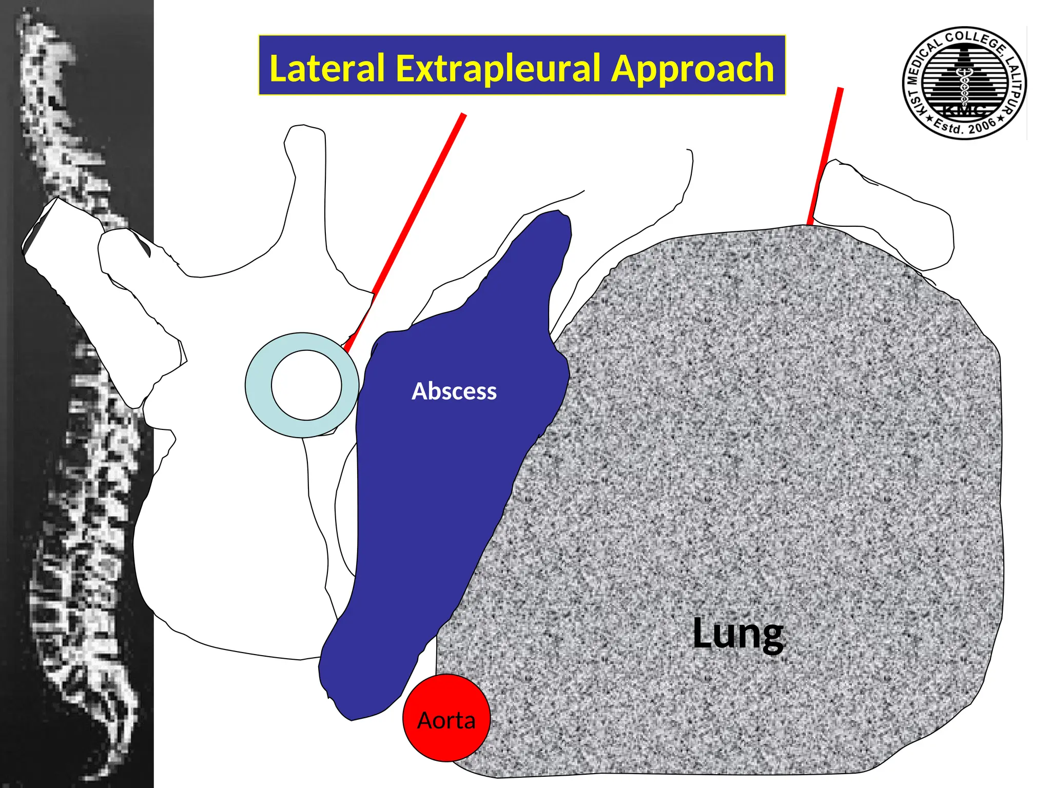 7. Presentation Spinal Tuberculosis-modified.ppt