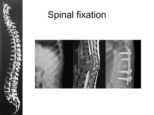 7. Presentation Spinal Tuberculosis-modified.ppt