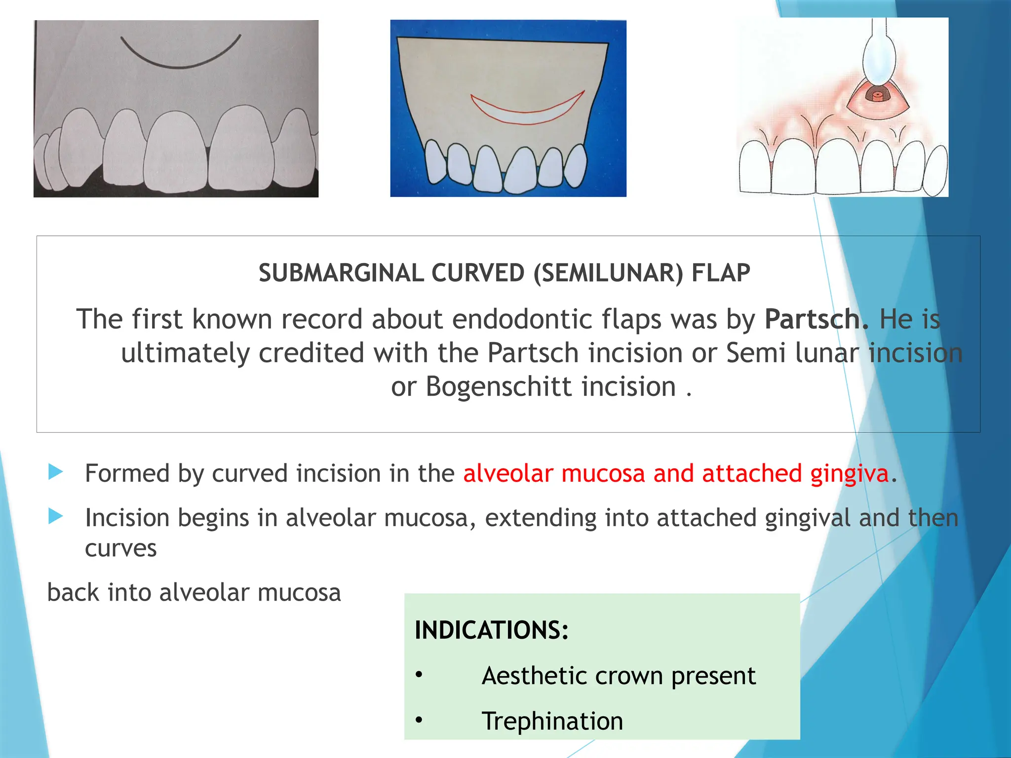 Various Flap Designs in Endodontic Surgery | PPTX