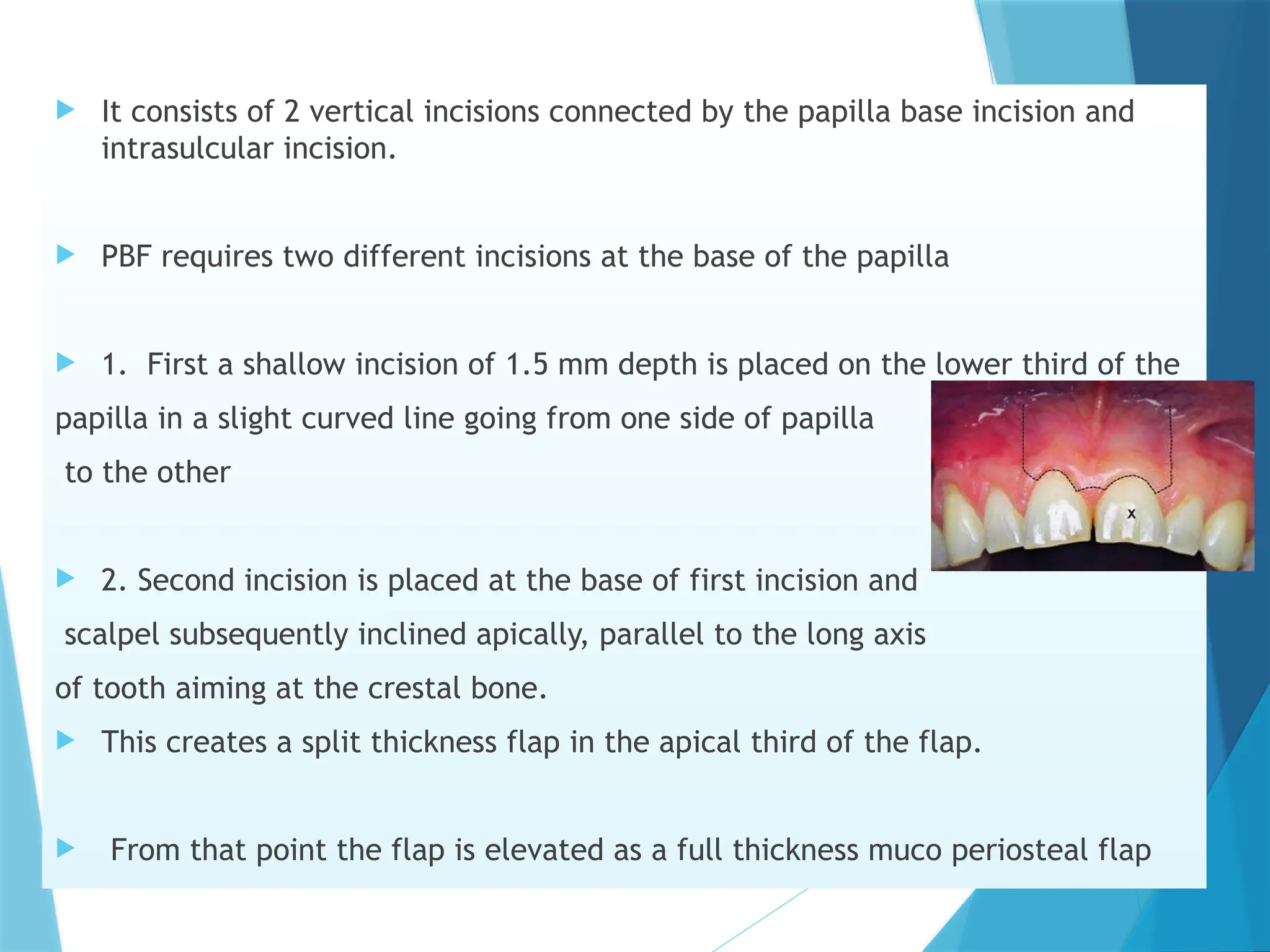 Various Flap Designs in Endodontic Surgery | PPTX